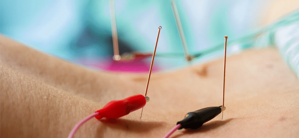 Dry Needling vs. Acupuncture: What’s the Difference?
